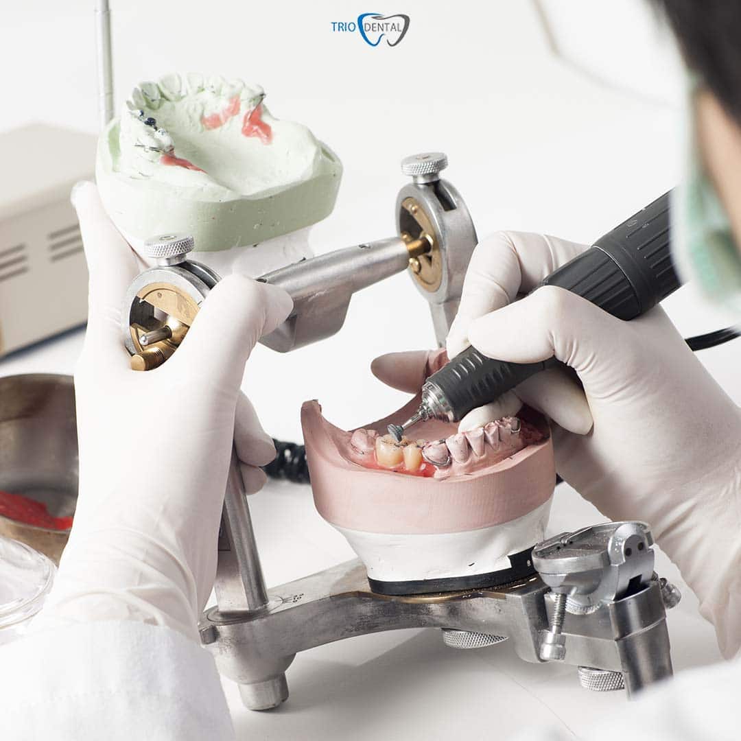 Prothèse dentaire squelettique Albanie | Trio Dental Center