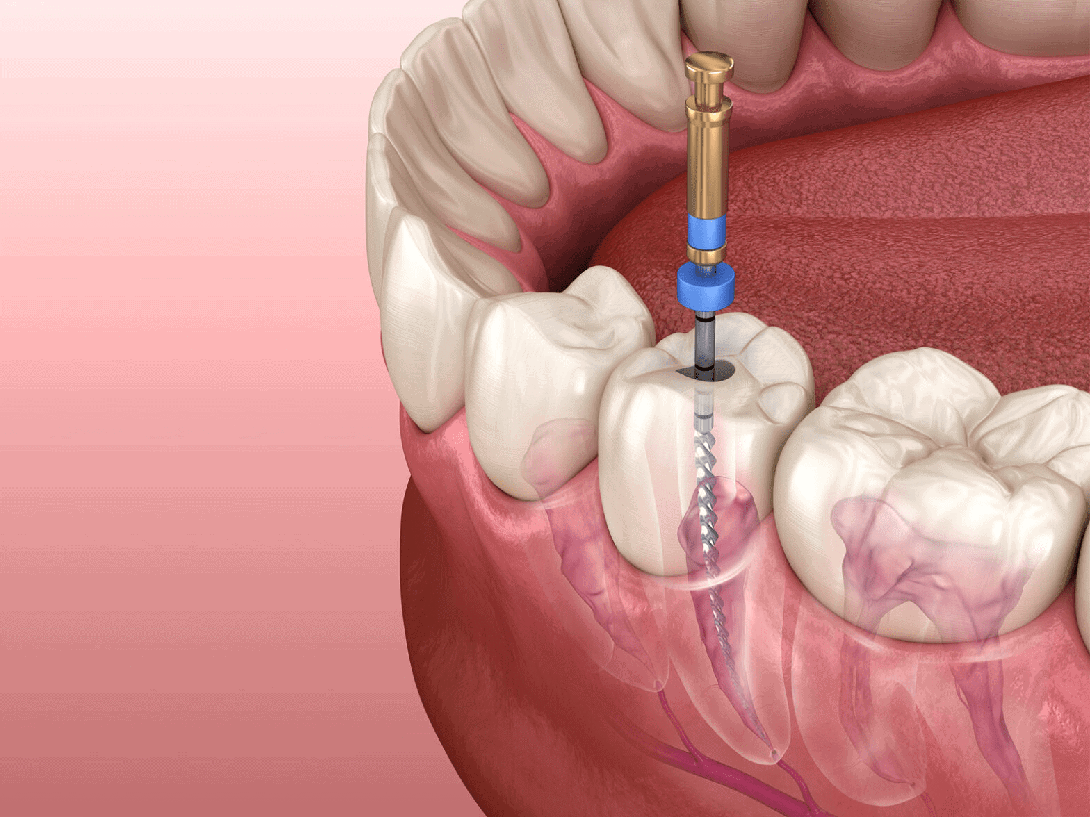 Denervation: When Is It Proceed And For What Reasons?